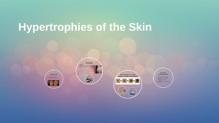 Hypertrophies of the Skin by on Prezi