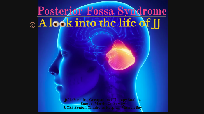 Posterior Fossa Syndrome by Julie Formica on Prezi