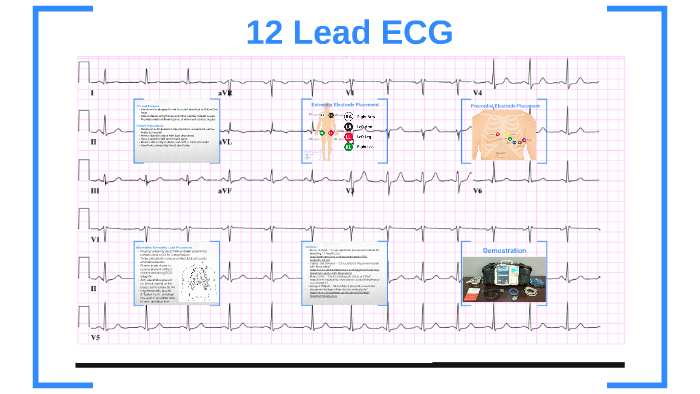 12 Lead ECG by Jacob Fuess on Prezi