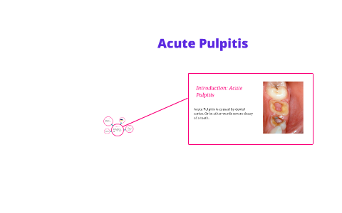 Acute Pulpitis by Alexis Biddle on Prezi