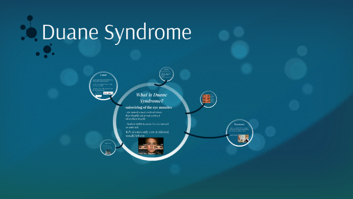 Duane Syndrome by Nicki Robertson on Prezi