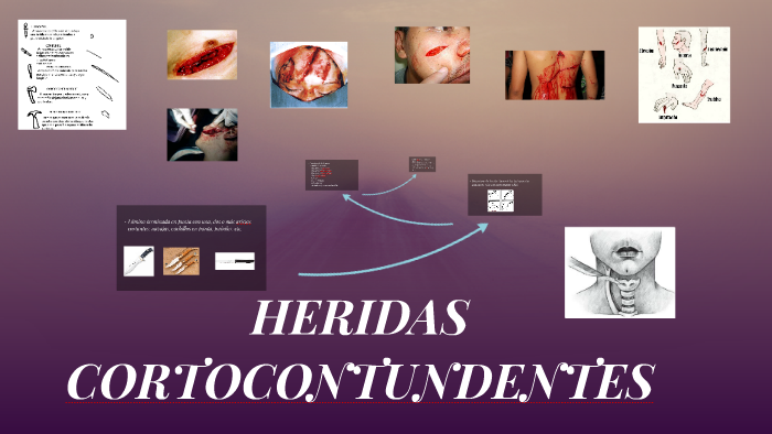 HERIDAS CORTOCONTUNDENTES by anahy german on Prezi