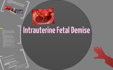 Intrauterine Fetal Demise by vanessa padecio on Prezi