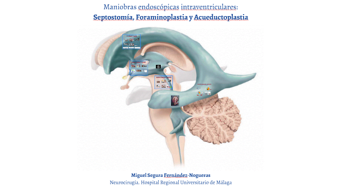 Maniobras endoscópicas intraventriculares: Septostomía, Foraminotomía y ...