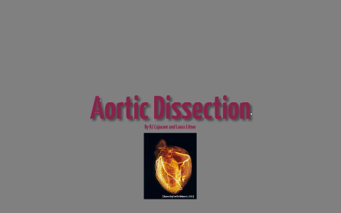 Aortic Dissection by Laura Litner on Prezi