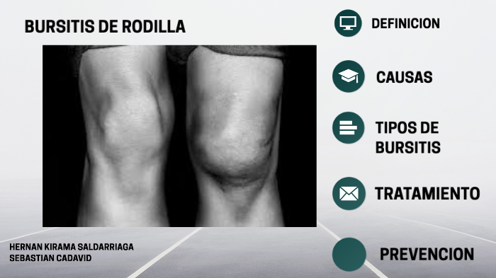 bursitis de rodilla by Gio Quirama on Prezi