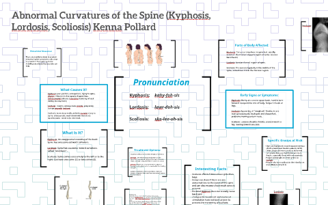 Abnormal Curvatures of the Spine (kyphosis, lordosis, scolio by Kenna ...