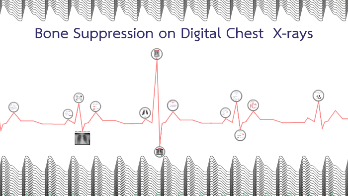 Bone Suppression on Digital Chest X-rays by on Prezi