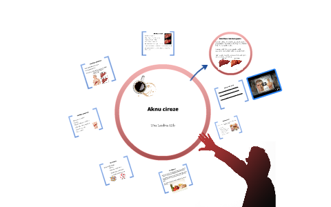 Aknu ciroze by Līna Lazdiņa on Prezi