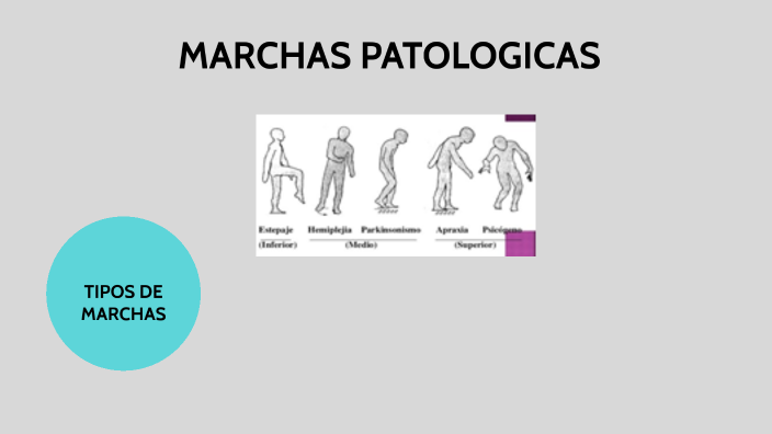 MARCHAS PATOLOGICAS by Adriana Helen santos quise on Prezi