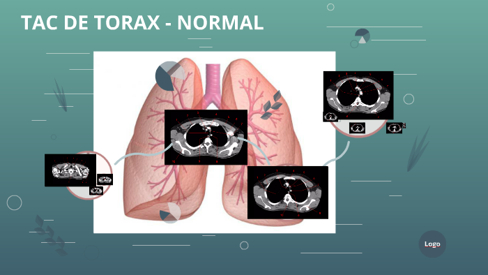 TAC DE TORAX NORMAL by Mayra Dorado on Prezi