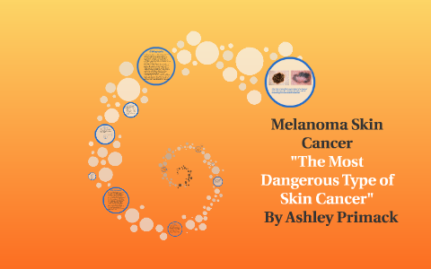 Skin Cancer by Ashley Primack on Prezi