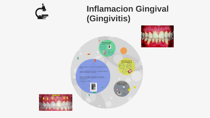 Inflamacion Gingival (Gingivitis) by Gerardo Torres on Prezi