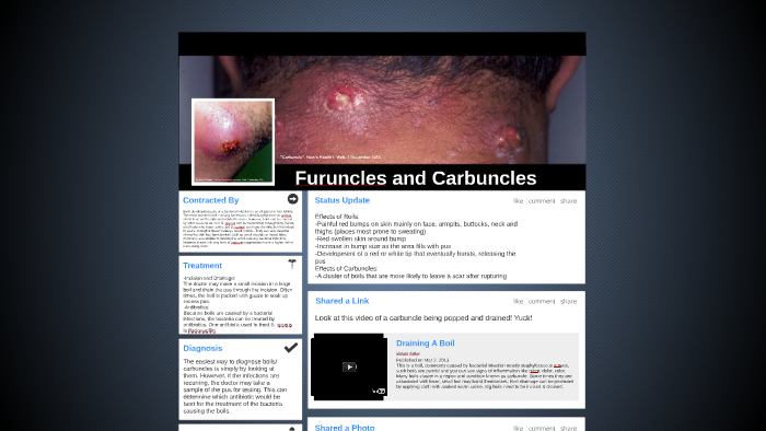 Furuncles and Carbuncles by Sarah Weidler on Prezi