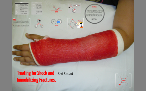 Treating for Shock and Immobilizing Fractures. by Kira Fellows