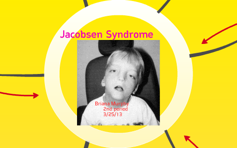 Jacobsen Syndrome by briana murphy on Prezi
