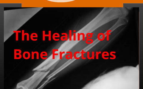 Healing of bone fractures by Patrick Mikos on Prezi