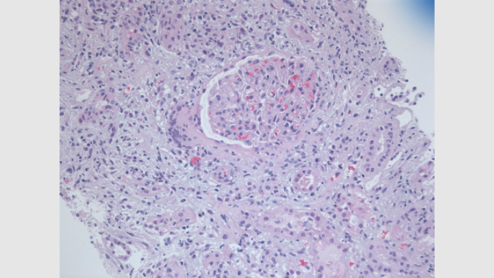 Polyarteritis Nodosa by Macy Martinson on Prezi