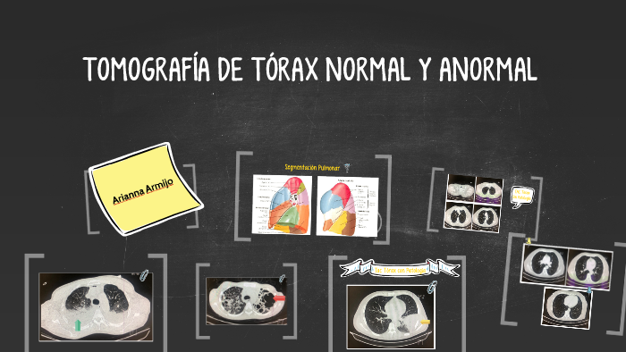 TOMOGRAFÍA DE TÓRAX NORMAL Y ANORMAL by Ariannaa Arm on Prezi