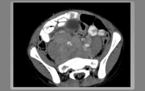 Investigation of Diffuse Lymphadenopathy in a Child by Stephen Marbut