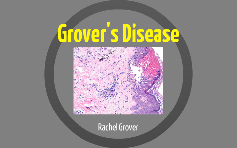 Grover's Disease by Rachel Grover on Prezi