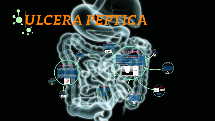 ULCERA PEPTICA by william ulloa zevallos on Prezi