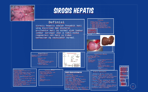 Sirosis Hepatis by deden sapta on Prezi