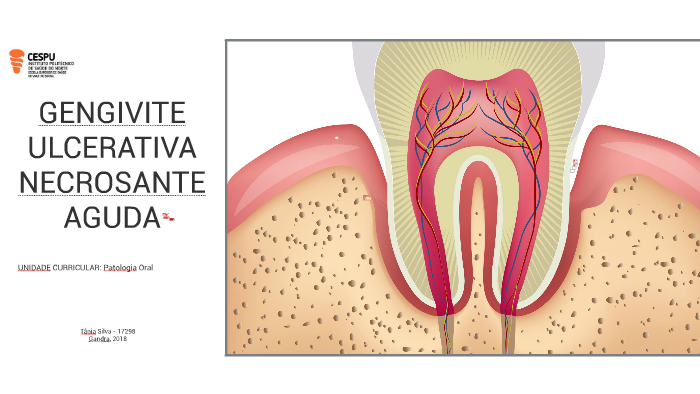 GENGIVITE ULCERATIVA NECROSANTE AGUDA by Grace silva on Prezi GENGIVITE ULCERATIVA NECROSANTE AGUDA by Grace silva on Prezi