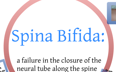 Spina Bifida by Taylor Helm on Prezi