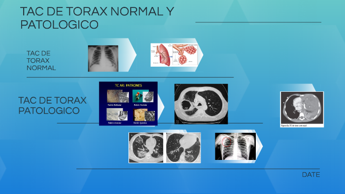 TAC DE TORAX NORMAL Y PATOLOGICO by Priscy Esther Reyes on Prezi