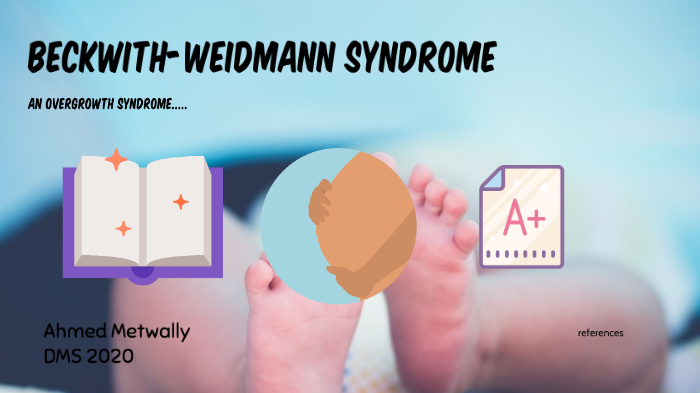 Beckwith-Weidmann Syndrome by AHMED METWALLY on Prezi