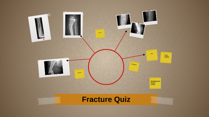 Fracture Quiz by on Prezi