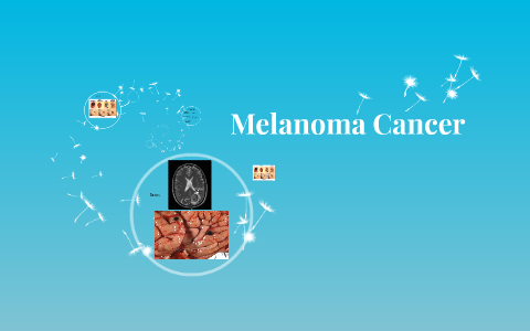 Melanoma by Chelsea McAdams on Prezi