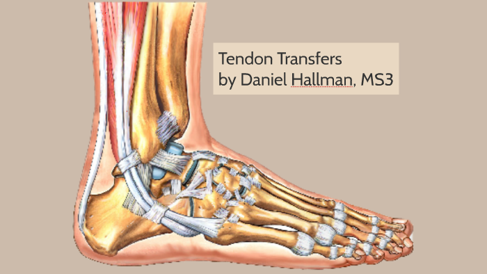 Tendon Transfers by Daniel Hallman on Prezi