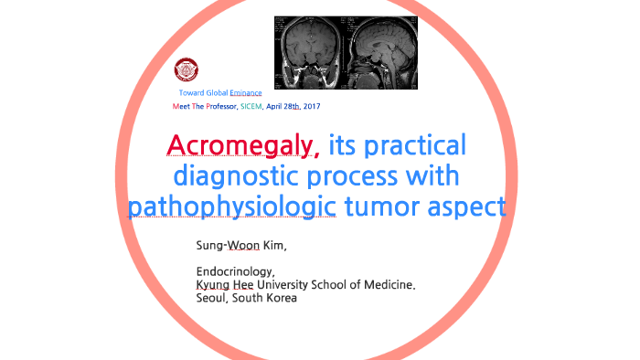 Acromegaly, its practical diagnostic process with pathophysiologic ...
