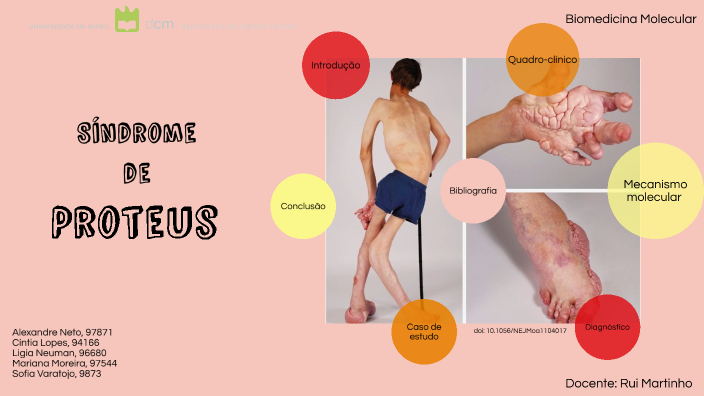 Síndrome de Proteus by Cíntia Lopes on Prezi