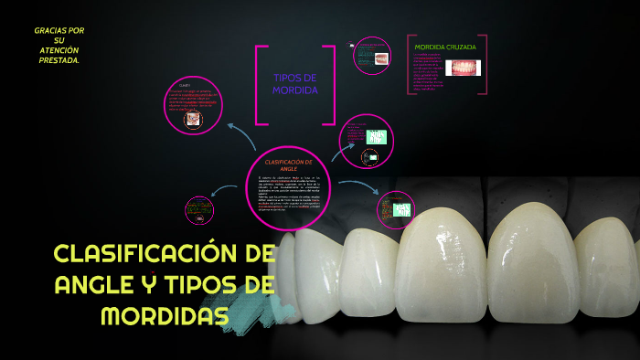 CLASIFICACION DE ANGLE by adriana scaldaferro on Prezi