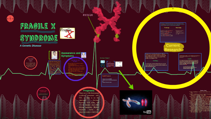 Fragile X Syndrome by Emily Zhang on Prezi