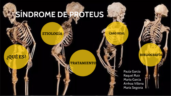 SÍNDROME DE PROTEUS by raquel ruiz diez on Prezi