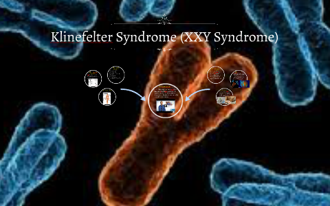 Klinefelter Syndrome (XXY Syndrome) by keyanna miller