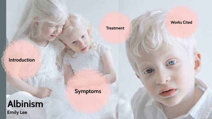 Albinism - Disorder Project by Emily Lee on Prezi