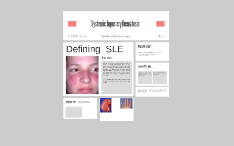 Systemic lupus erythematosis by colton grantham on Prezi