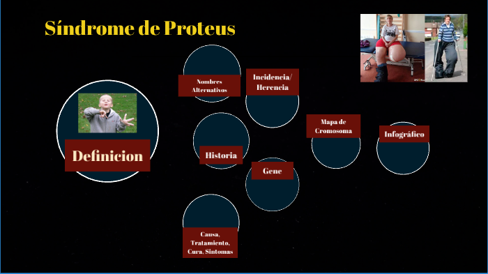 Síndrome de Proteus by Kimberly Lara on Prezi