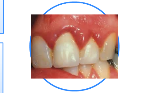 Tratamiento de inflamacion gingival by jessy santos on Prezi