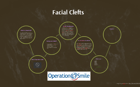 Facial Clefts by Tyler Pressley on Prezi