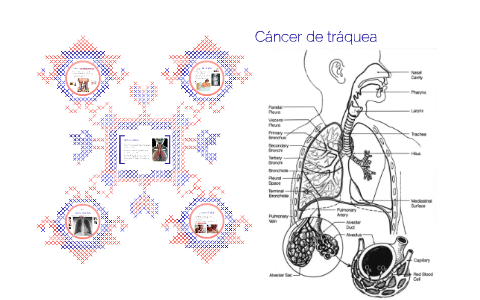 Cáncer de tráquea by Eduardo Saavedra Romero on Prezi