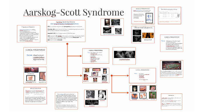 Aarskog-Scott Syndrome by Lori Snyder on Prezi