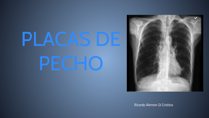 PLACAS DE PECHO by Ricardo DiCristina on Prezi