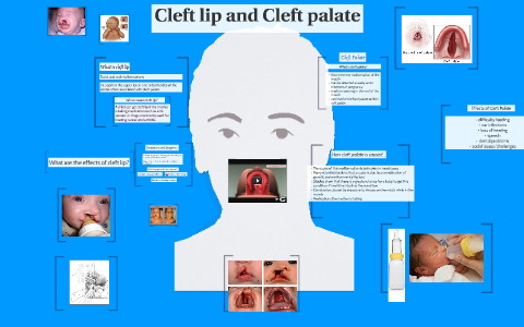 Cleft lip/ Palate by Vanessa Vigil on Prezi