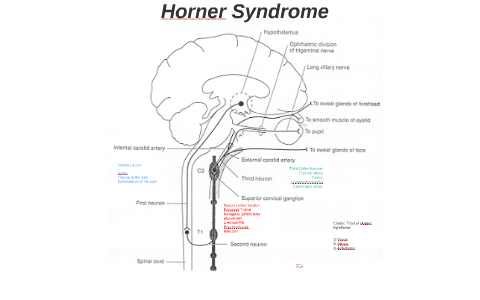 Classic Triad of Horner's Syndrome: by Joseph Andrie on Prezi